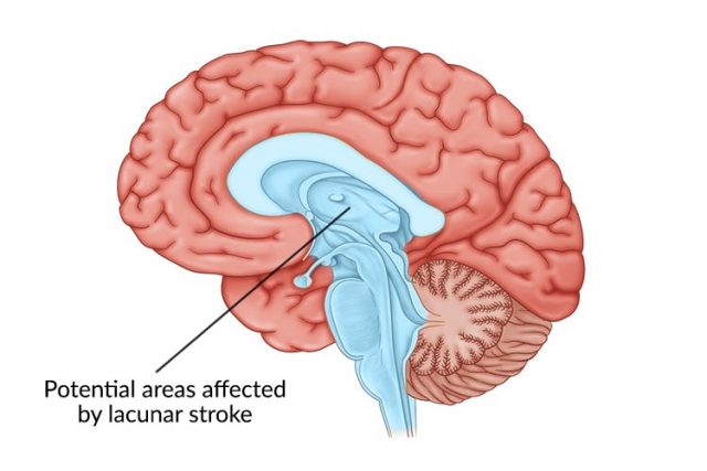 Lacunar Stroke: Understanding the Causes, Symptoms, and Treatment – Zao ...
