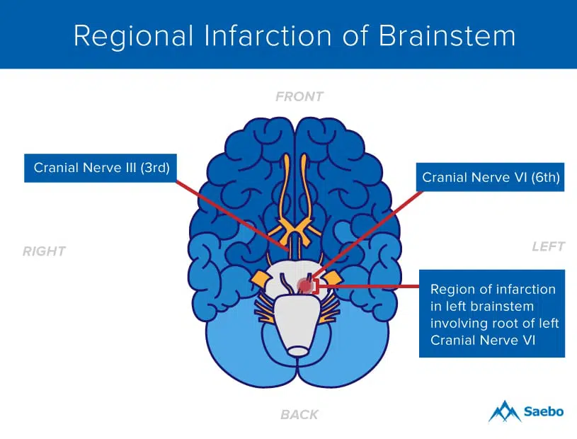 What is a Brainstem Stroke? – Zao Rehab